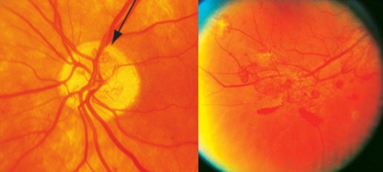 Diabetic retinopathy grading and classification - EyeSteve.com Diabetic retinopathy grading and classification - EyeSteve.com