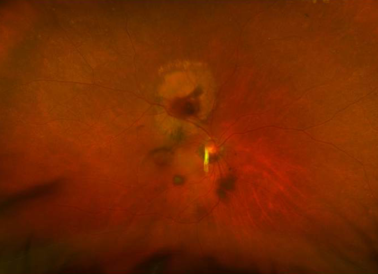 Retinal Artery Macroaneurysm (RAMA) - EyeSteve.com
