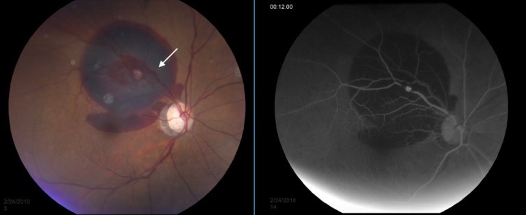 Retinal Artery Macroaneurysm (RAMA) - EyeSteve.com